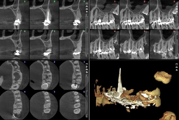 Endodontic imaging mode