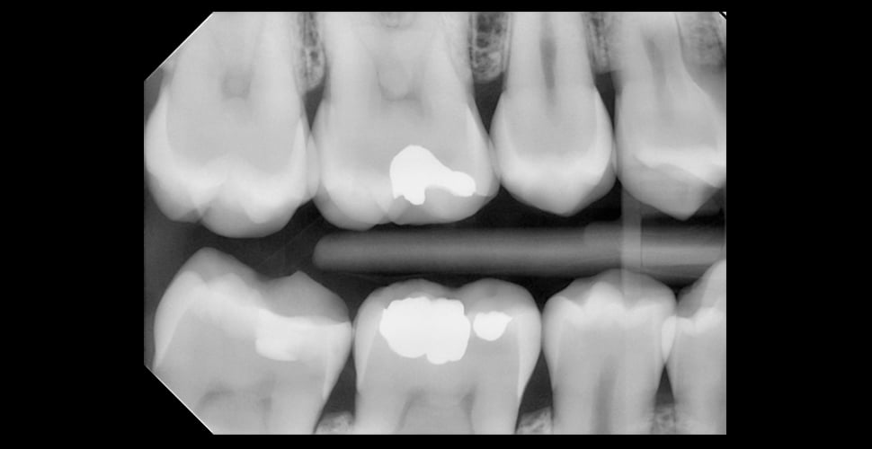 Clinical images | Planmeca ProSensor HD