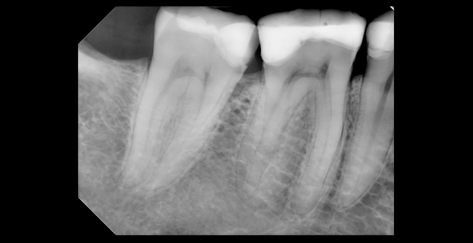 Clinical images | Planmeca ProSensor HD