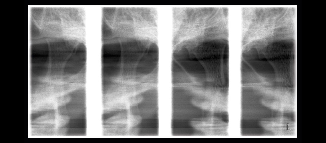 Clinical images | Planmeca ProOne